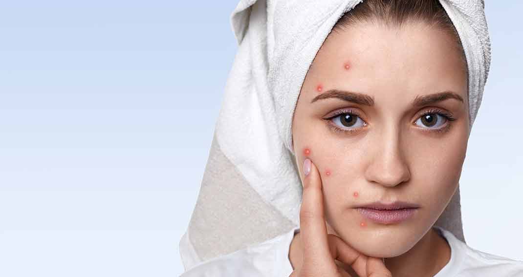 فوائد ديرما تي لعلاج حب الشباب بالسعر وطريقة الاستخدام