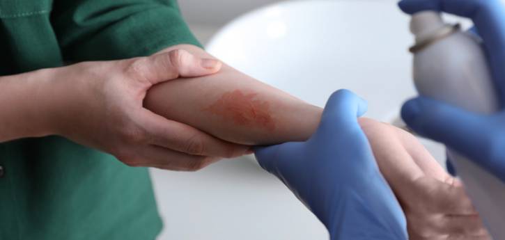 اليك تجربتي مع كريم فلامازين للحروق بالسعر | كوني مميزة